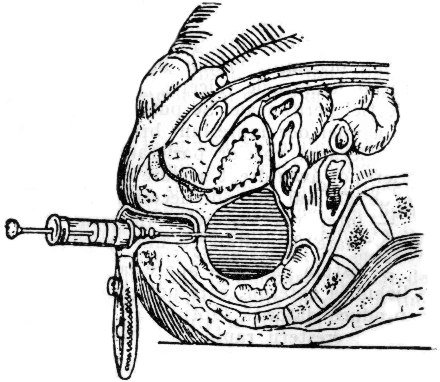PUNCTIA PERITONEALA referat